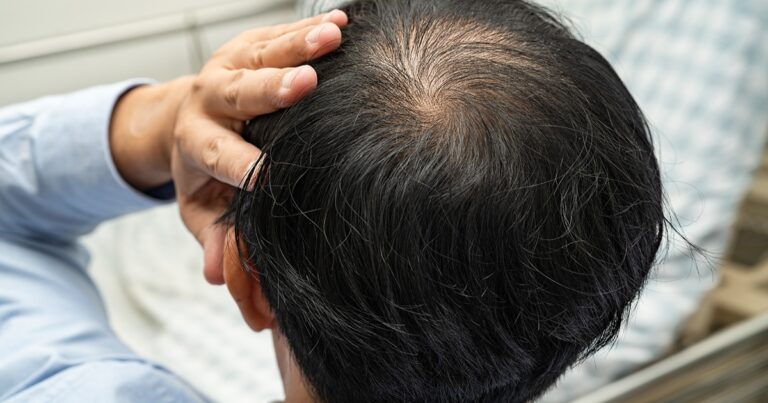 ¿Qué es la calvicie en la coronilla? Causas, síntomas y tratamientos ...